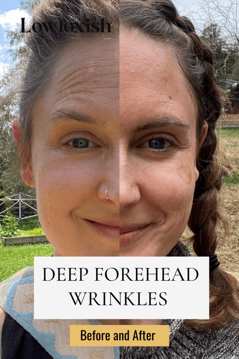 Amazing Deep Forehead Wrinkles Before and After